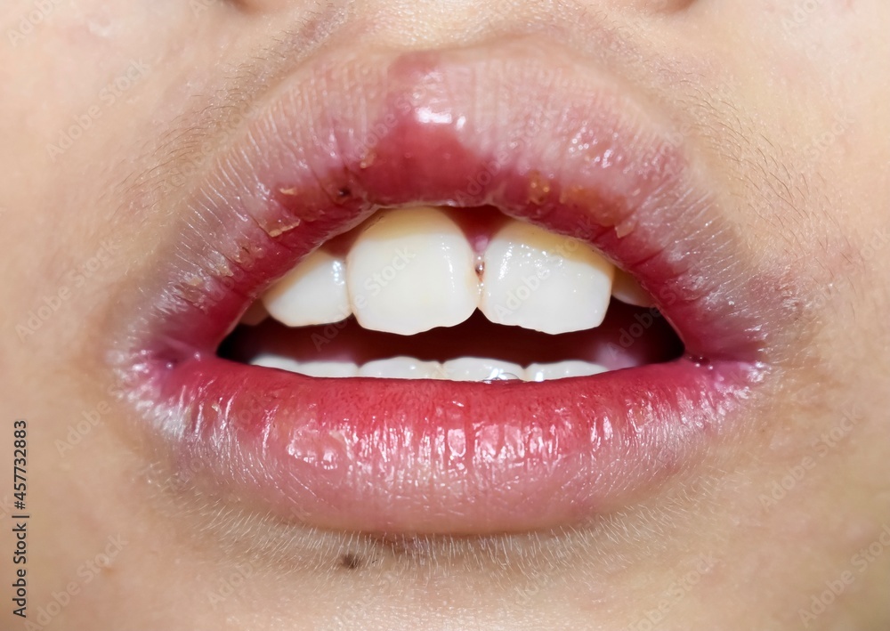 Zdjęcie Stock: Angular stomatitis or angular cheilitis or perleche in ...