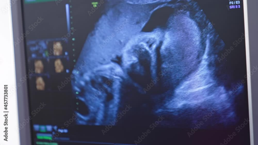 Screen shows a future child on ultrasonography. Baby during ultrasound ...