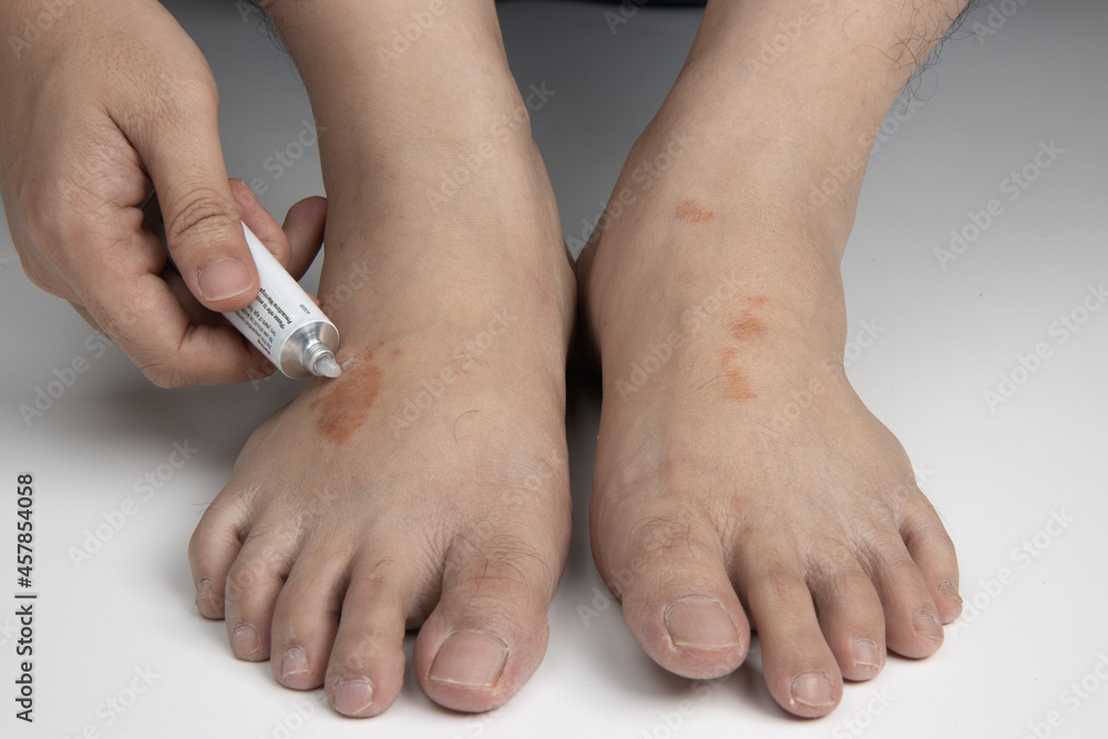 hand applying medication cream, gel or ointment on foot infected by ...