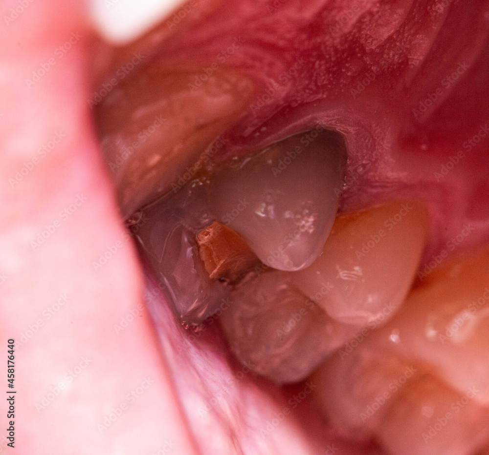 Chipped piece of a dead pulp tooth. Restoration of a damaged tooth in ...
