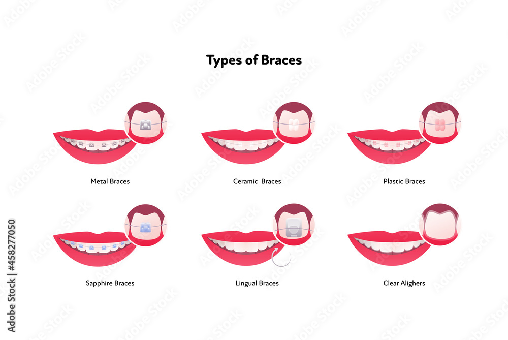 Dental teeth braces types infographic. Vector flat healthcare ...