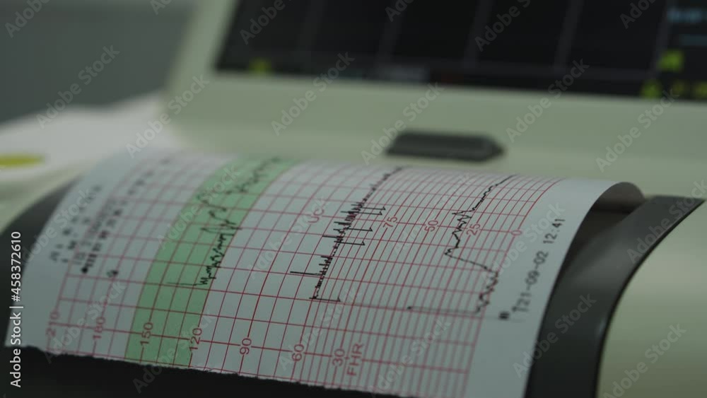 Electronic Cardiotocography Machine Monitoring Fetal Heart Contractions ...