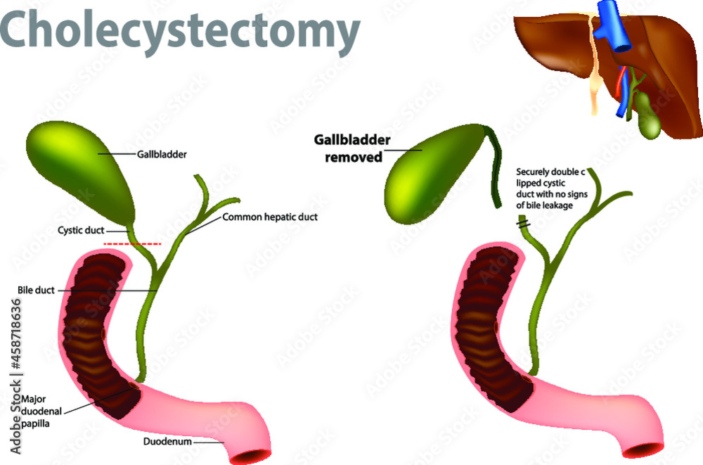 Gallbladder Removal Surgery. Laparoscopic cholecystectomy. Gallbladder ...