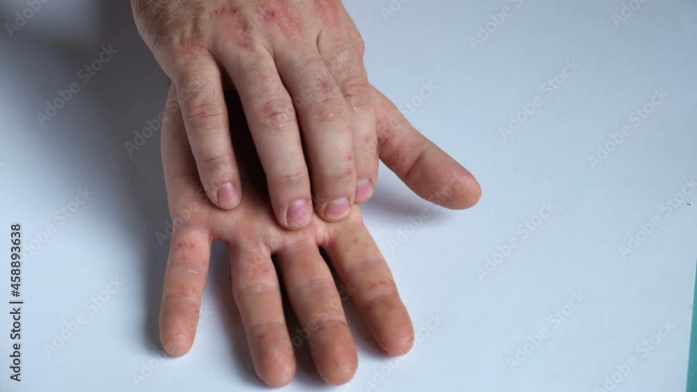 Painful rash, red spots blisters on the hand. Close up Allergy rash ...