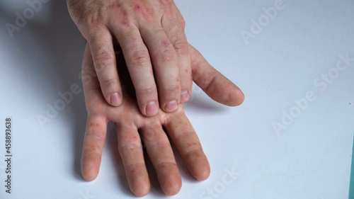 Painful rash, red spots blisters on the hand. Close up Allergy rash ...