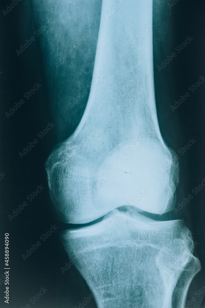 X-ray of the knee joint. Leg and kneecap injury Stock Photo | Adobe Stock