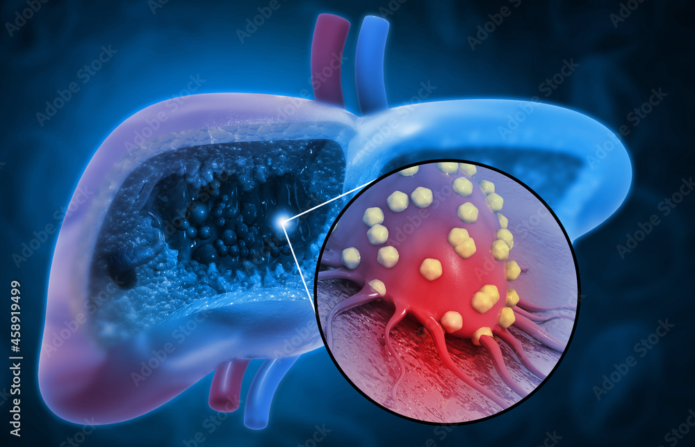 ภาพประกอบสต็อก Liver disease. Liver infection. Viral infection. 3d ...