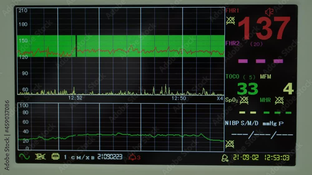 Electronic Cardiotocography Machine Monitoring Fetal Heart Contractions ...