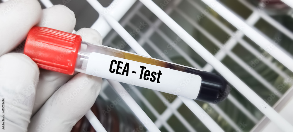 Blood sample for CEA(carcinoembryonic antigen) test, tumor marker for ...