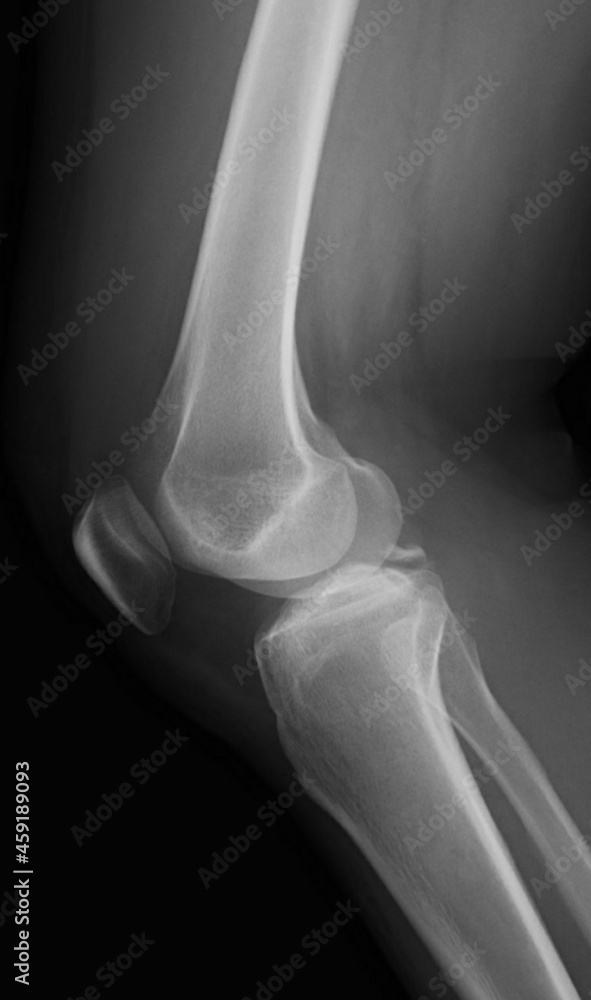 Foto de x ray image of knee posterior cruciate ligament (PCL) avulsion ...