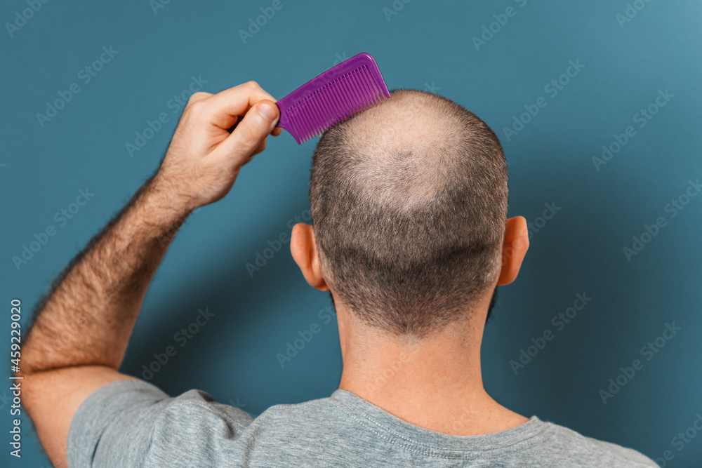 A man combs his bald head with a comb. Blue background. Rear view. The ...