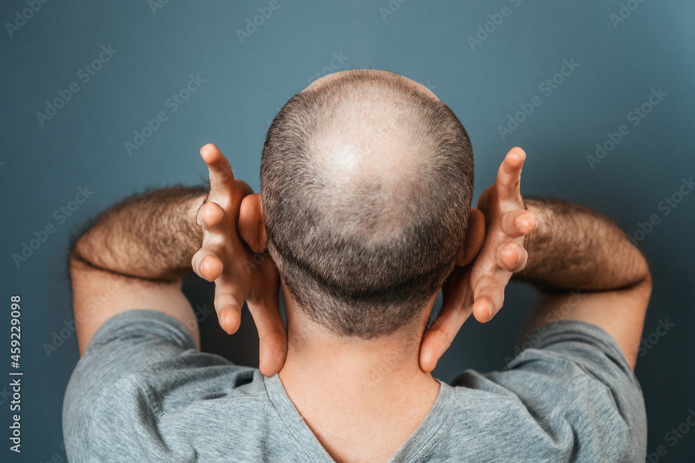 Baldy man suffering because of his appearance. Person grabs his head ...