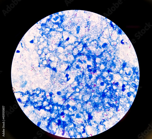 Pulmonary Tuberculosis ( TB ) : Sputum AFB stain microscopic image. To ...