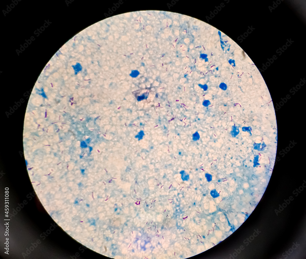 Pulmonary Tuberculosis ( TB ) : Sputum AFB stain microscopic image. To ... Pulmonary Tuberculosis ( TB ) : Sputum AFB stain microscopic image. To ...