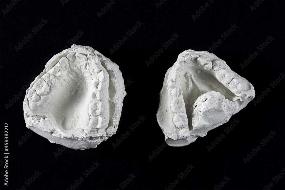 Cast of the jaw made of plaster on black background. Teeth cast for ...