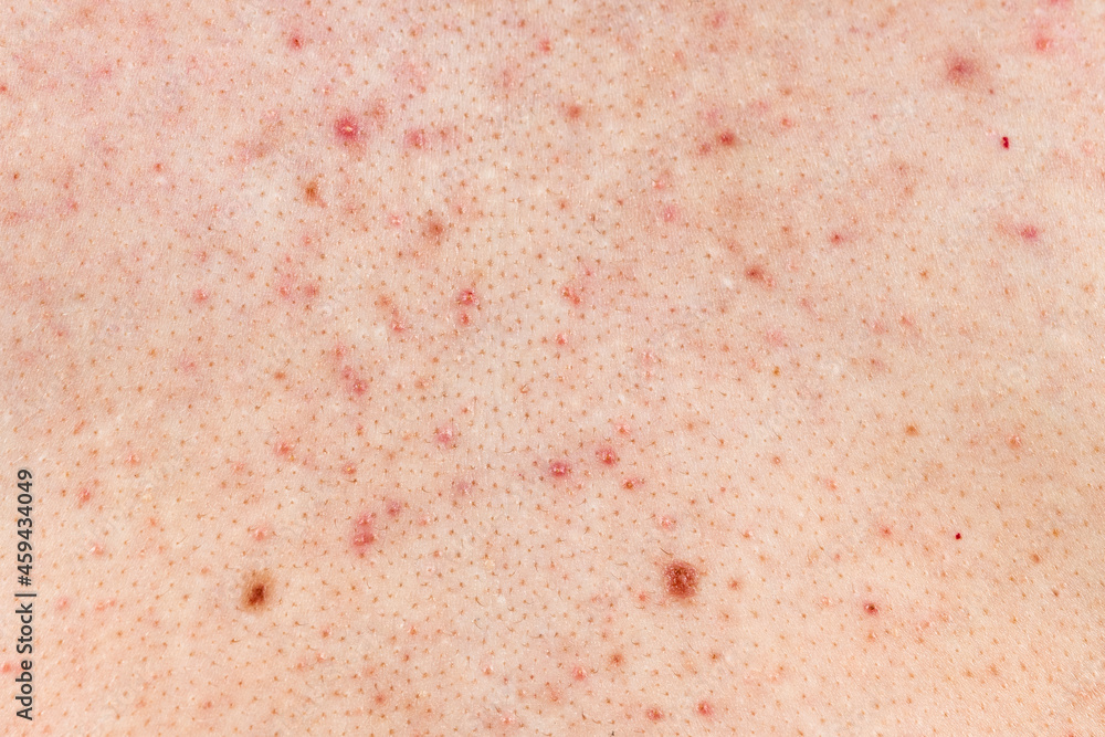 Skin background texture with pimples and blackheads. problematic skin ...