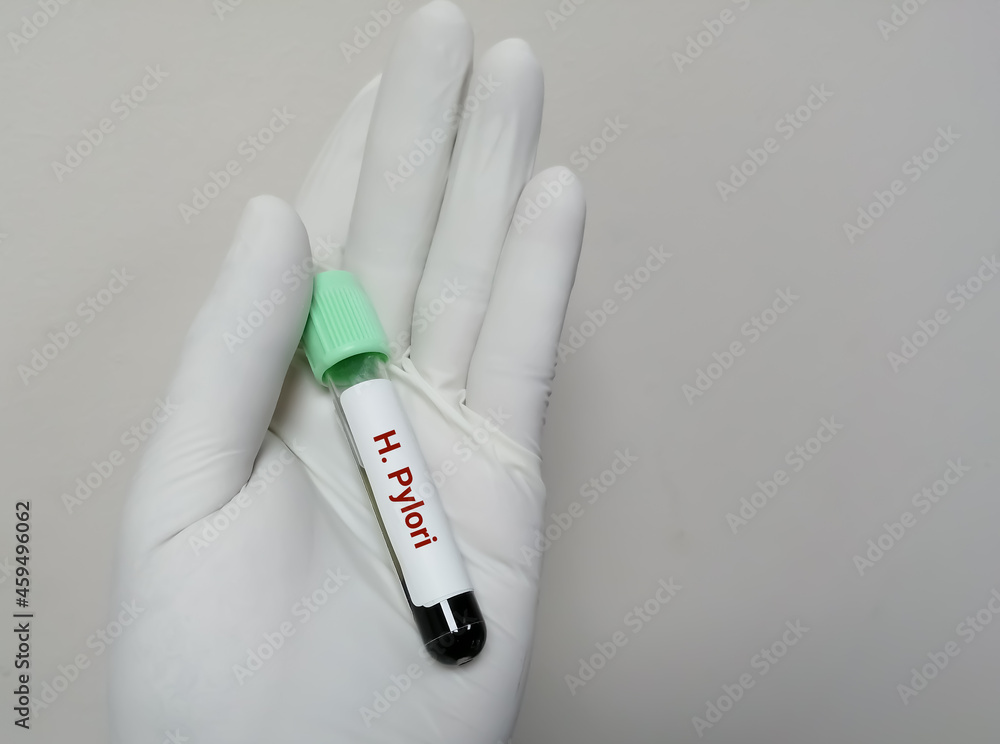 Blood sample for H. Pylori (Helicobacter pylori) test Stock Photo ...