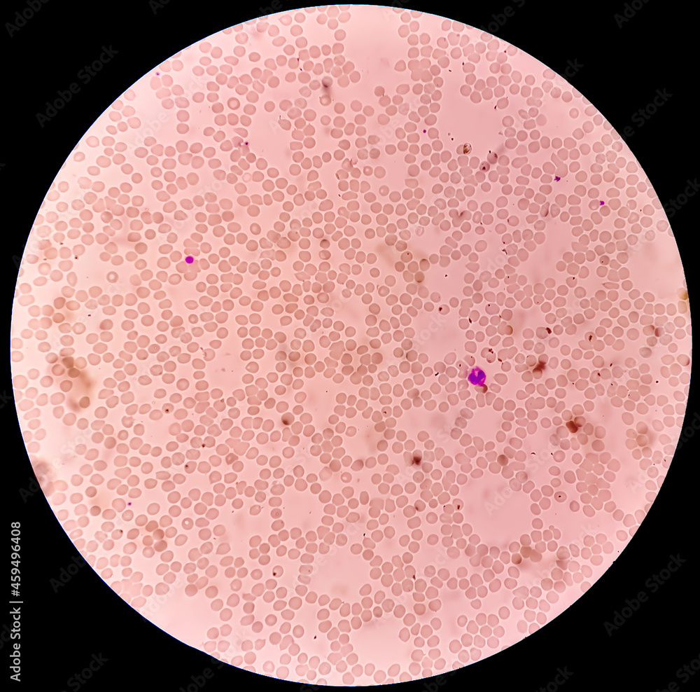 Microscopic view of hematological stained slide. thrombocytopenia Stock ...