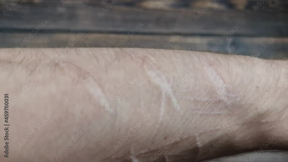 The Scars on the arm. Cut marks on the arm. Hand injuries. Scars on the ...