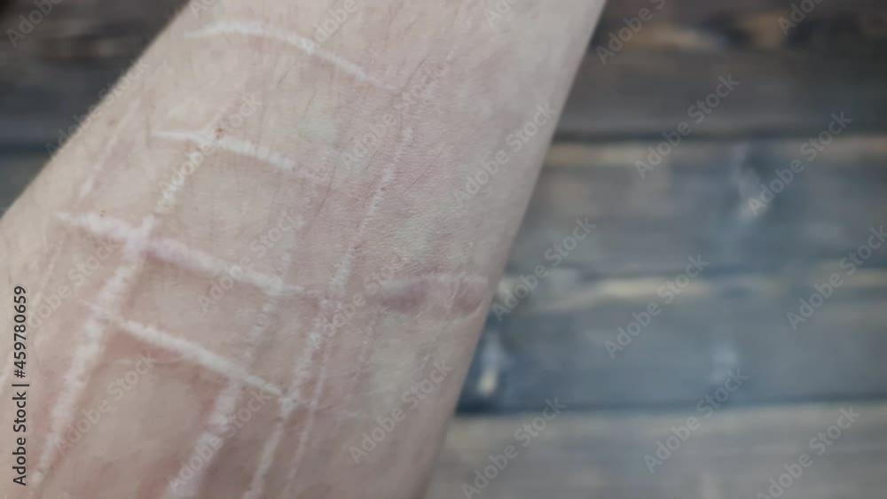 Vidéo Stock The Scars on the arm. Cut marks on the arm. Hand injuries ...