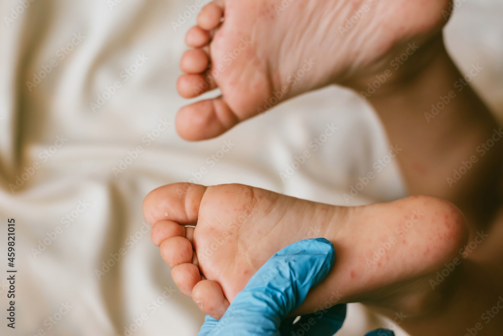 Rash of enterovirus infection picornavirus families on the feet of a 3 ...