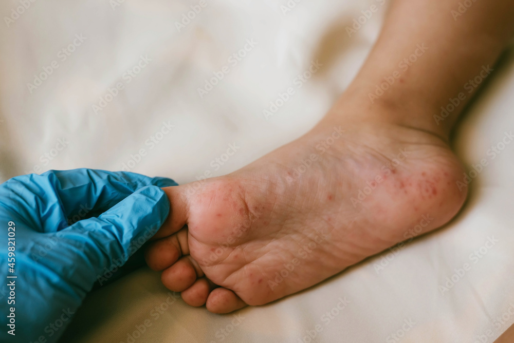 Rash of enterovirus infection picornavirus families on the feet of a 3 ...