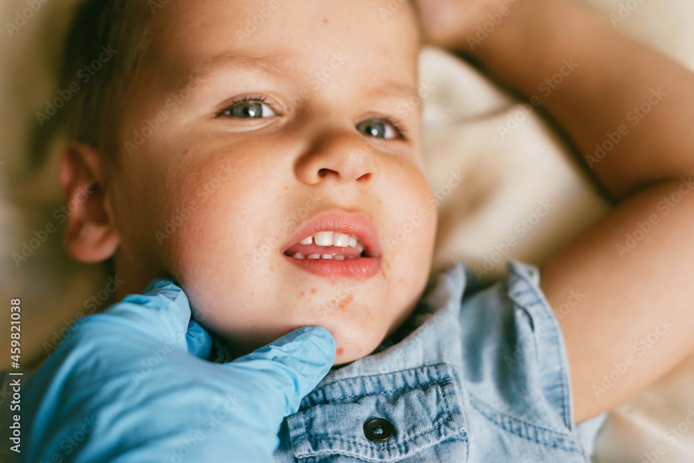 Rash of enterovirus infection picornavirus families on the face of a 3 ...