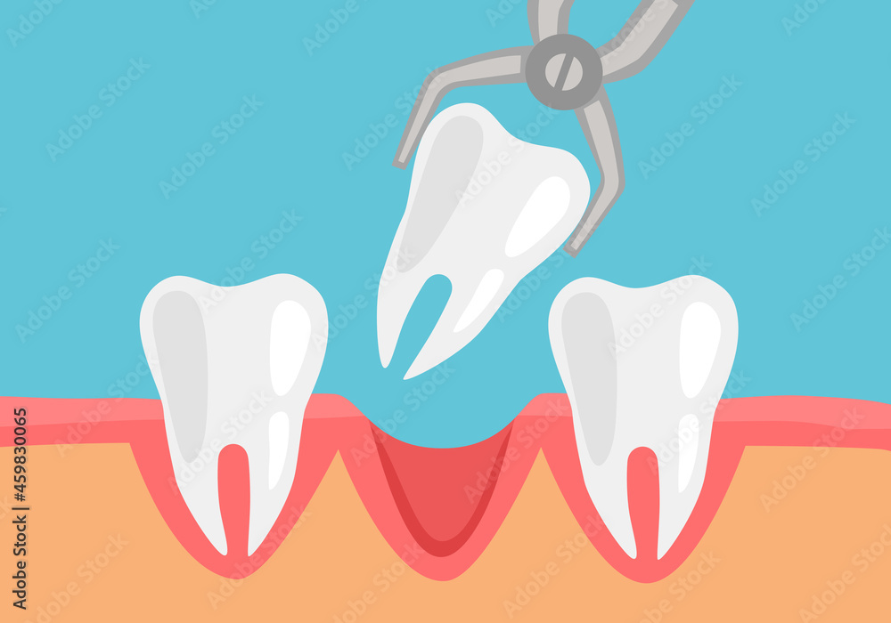 Unhealthy tooth removal process concept vector illustration. Dental ...