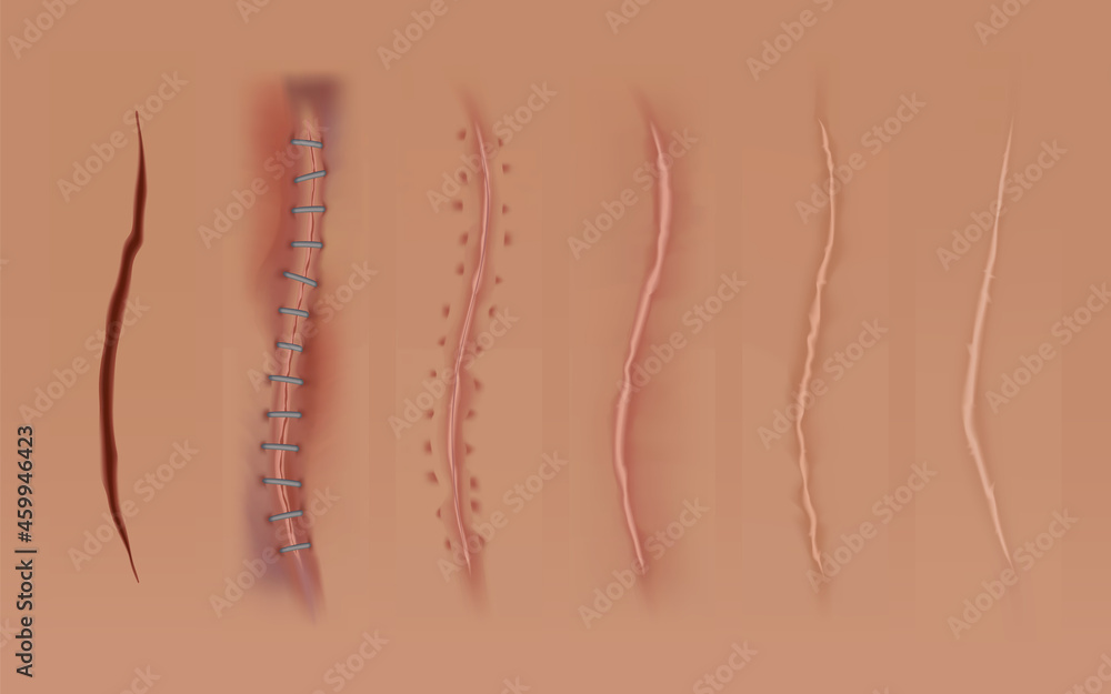 Set of healing wounds, skin scars, stitched gash and cuts. Realistic ...
