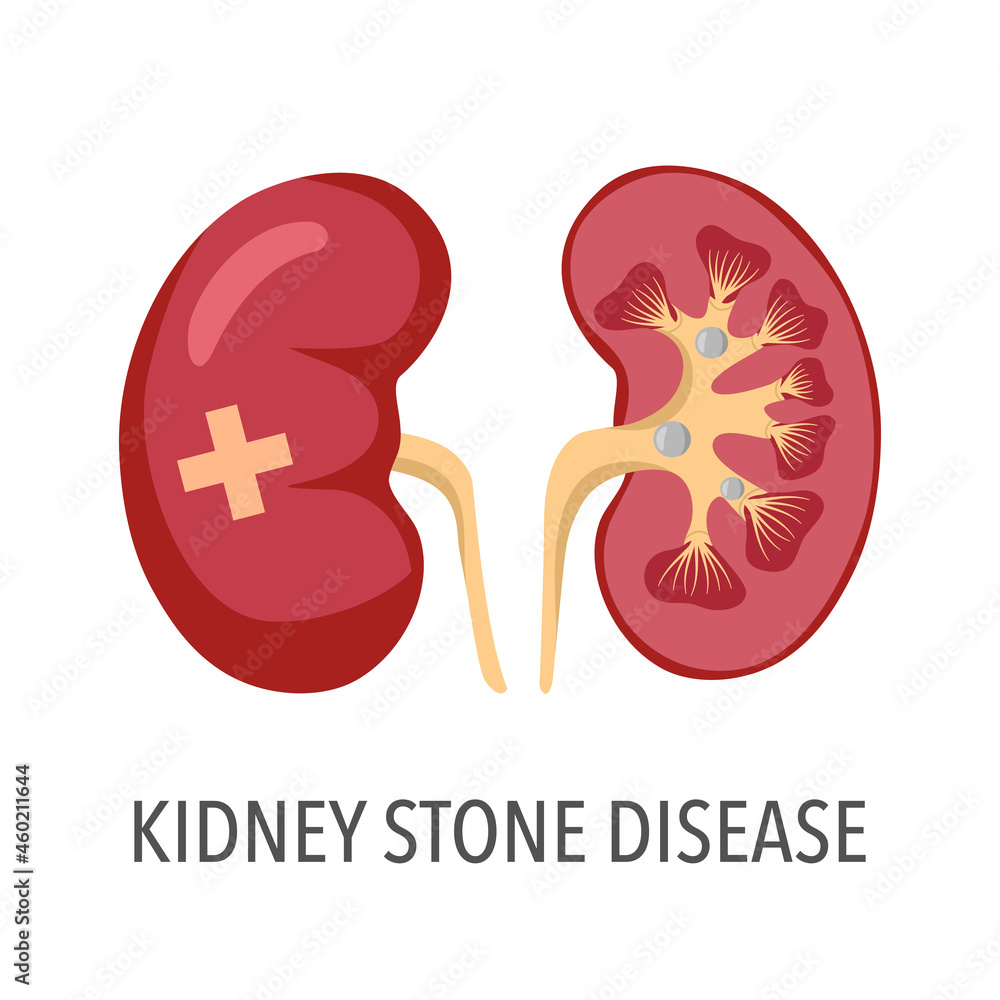 Kidney stone disease concept vector illustration on white background ...