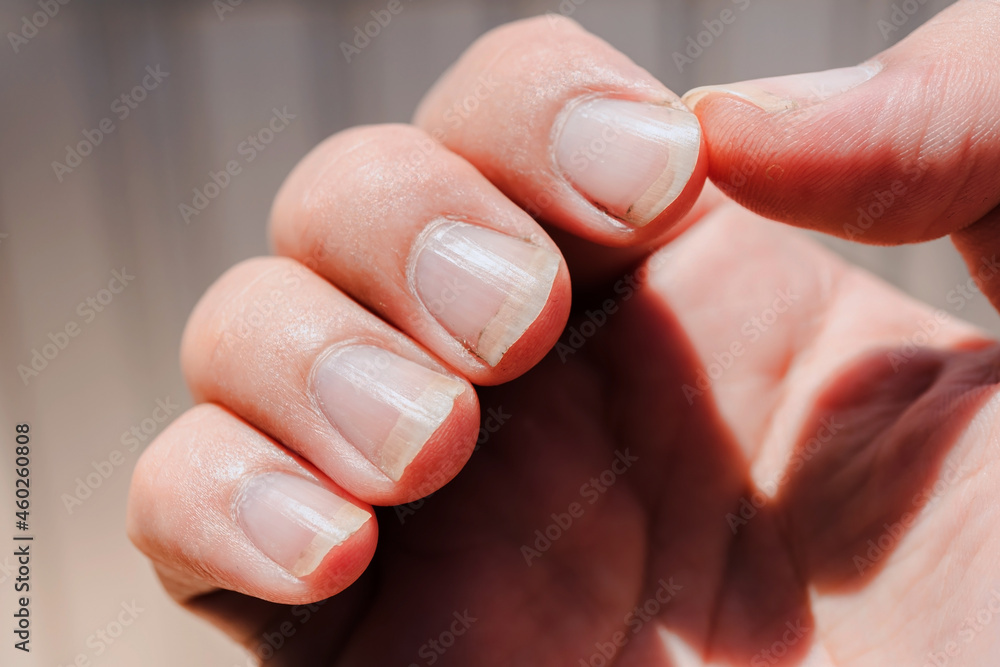 Very dirty nails, Show the dirty cut nails, which require urgent ...