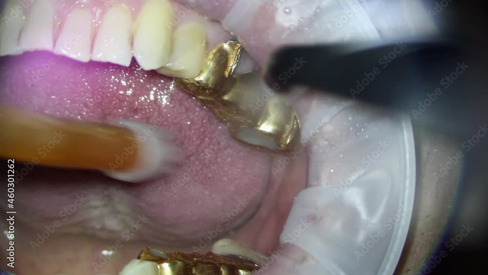before the operation to remove the dental gold bridge from the upper ...
