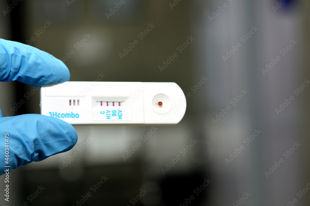 Positive result of HIV AIDS, HCV and positive HBV in a rapid test ...