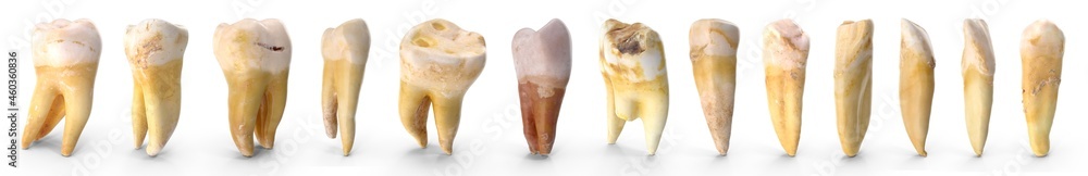 Rotten bad teeth. Caries. Erosion. Periodontal disease. Dental tartar ...