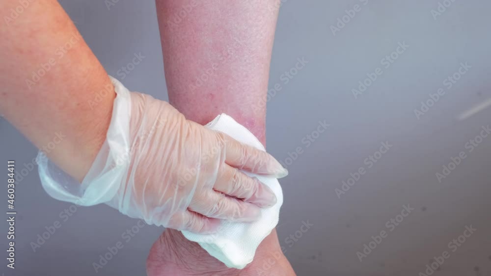 female doctor assistant examines and treats leg woman with scratches ...