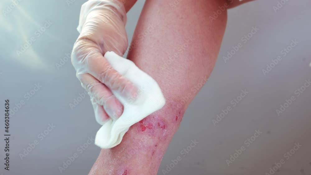 female doctor assistant examines and treats leg woman with scratches ...