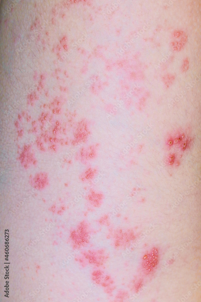 Herpes zoster blisters Stock Photo | Adobe Stock