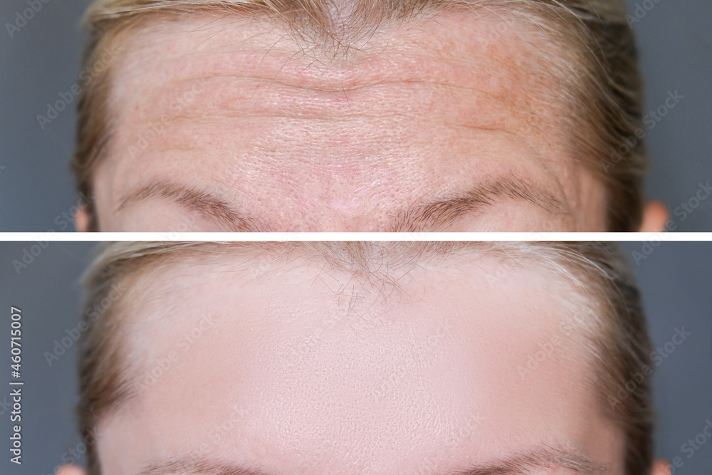 Deep mimic forehead wrinkles before and after treatment, smoothing and ...