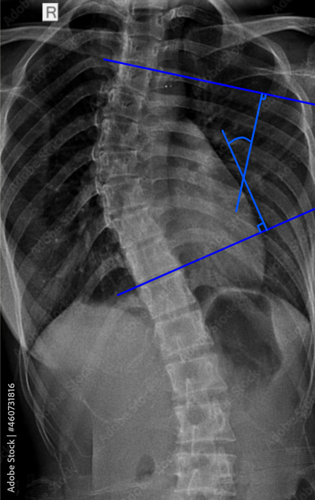 Scoliosis X Ray Cobb Angle