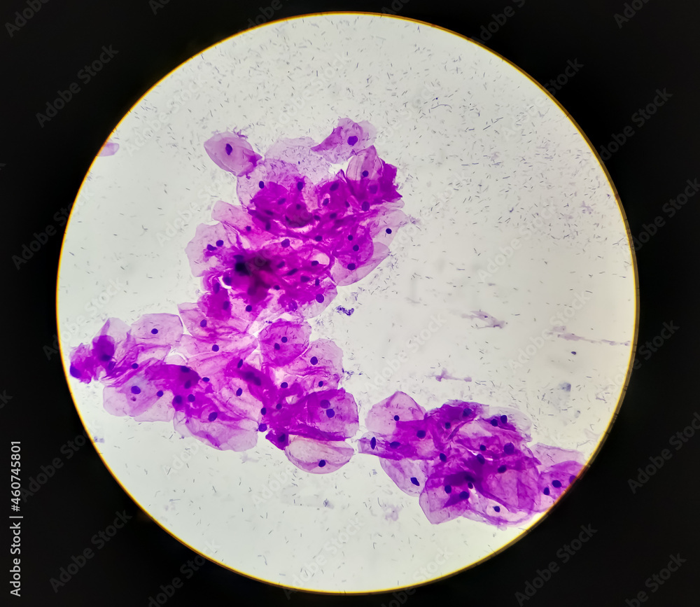 Pap's smear Cytology microscopic 100x show normal human cervix cells ...