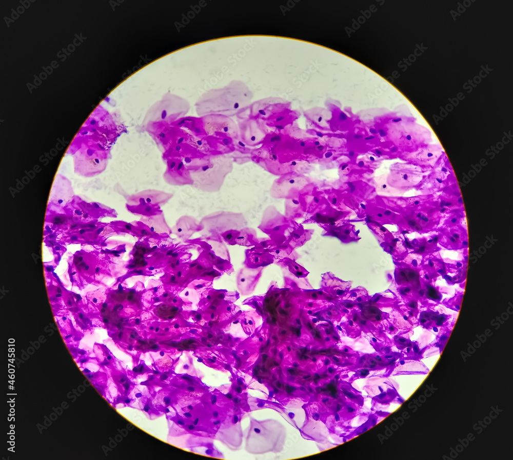 Pap's smear Cytology microscopic 100x show normal human cervix cells ...