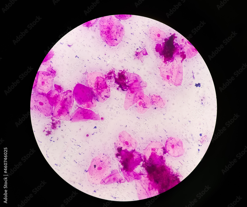 Microscopic close view of high vaginal swab Gram stain smear, 40x ...