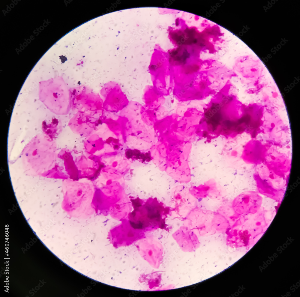 Microscopic Close View Of High Vaginal Swab Gram Stain Smear 40x