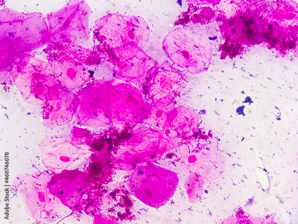 High Vaginal Swab Gram Stain Microscopic 100x Show Few Pus Cells And