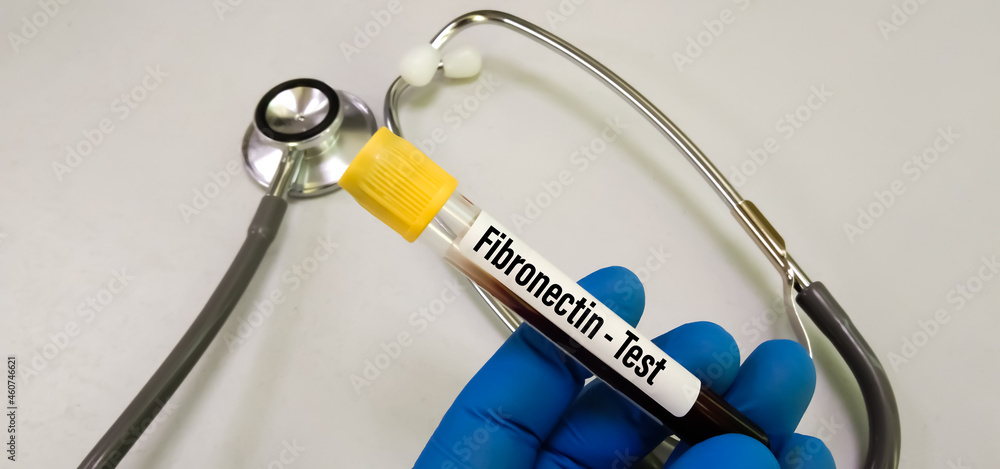 Blood sample tube for Fibronectin test. To diagnosis a pregnant woman’s ...