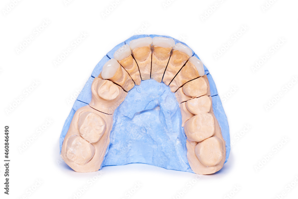 Veneers and crowns isolated on white background. Plaster model of teeth ...