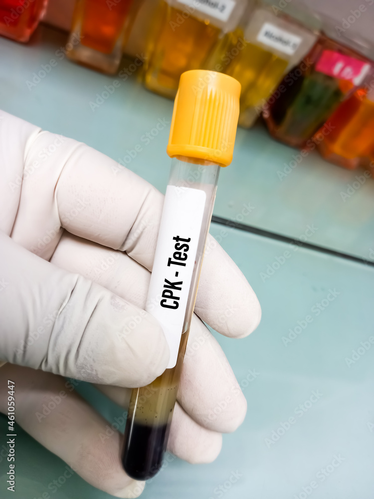 Foto de Blood sample for CPK( Creatine kinase) test, diagnosis for ...