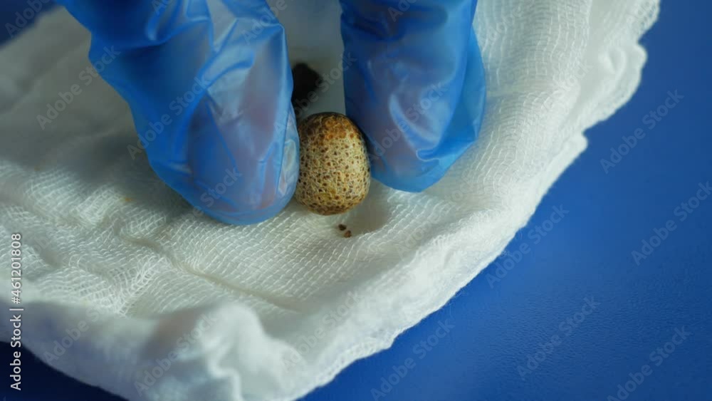 Removed gallstones on compress after gallbladder laparoscopic surgery ...