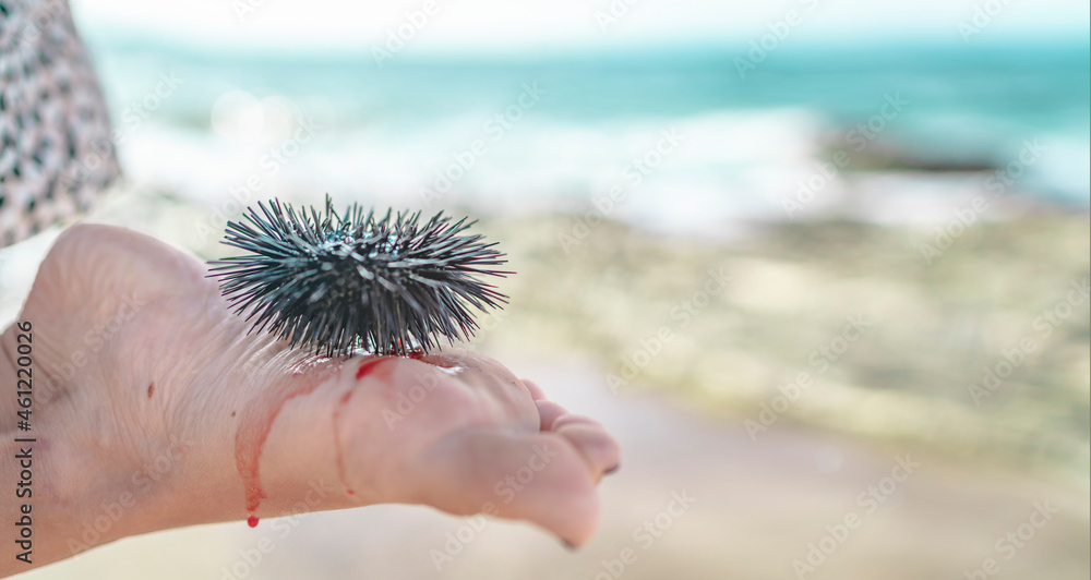 Das tut weh, der Seeigel steckt mit seinen Stacheln im Fuß und es ...