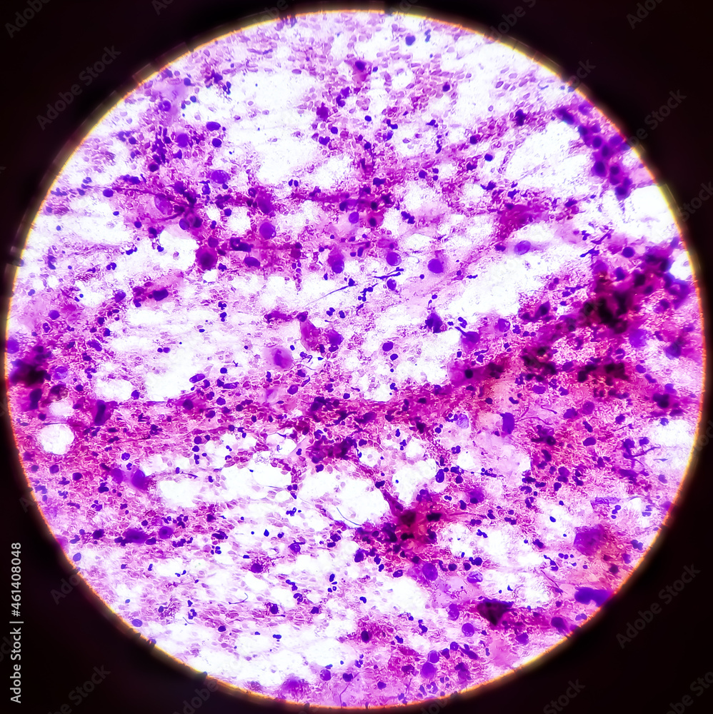 Microscopic view of Metastatic squamous cell carcinoma, atypical ...